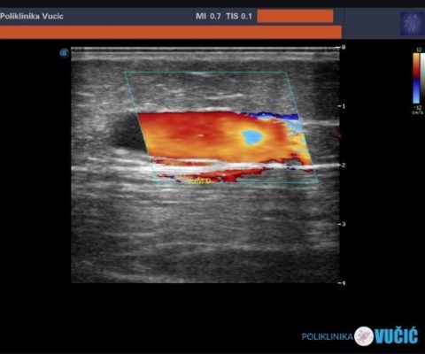 Color doppler vena i arterija nogu - Poliklinika Vučić